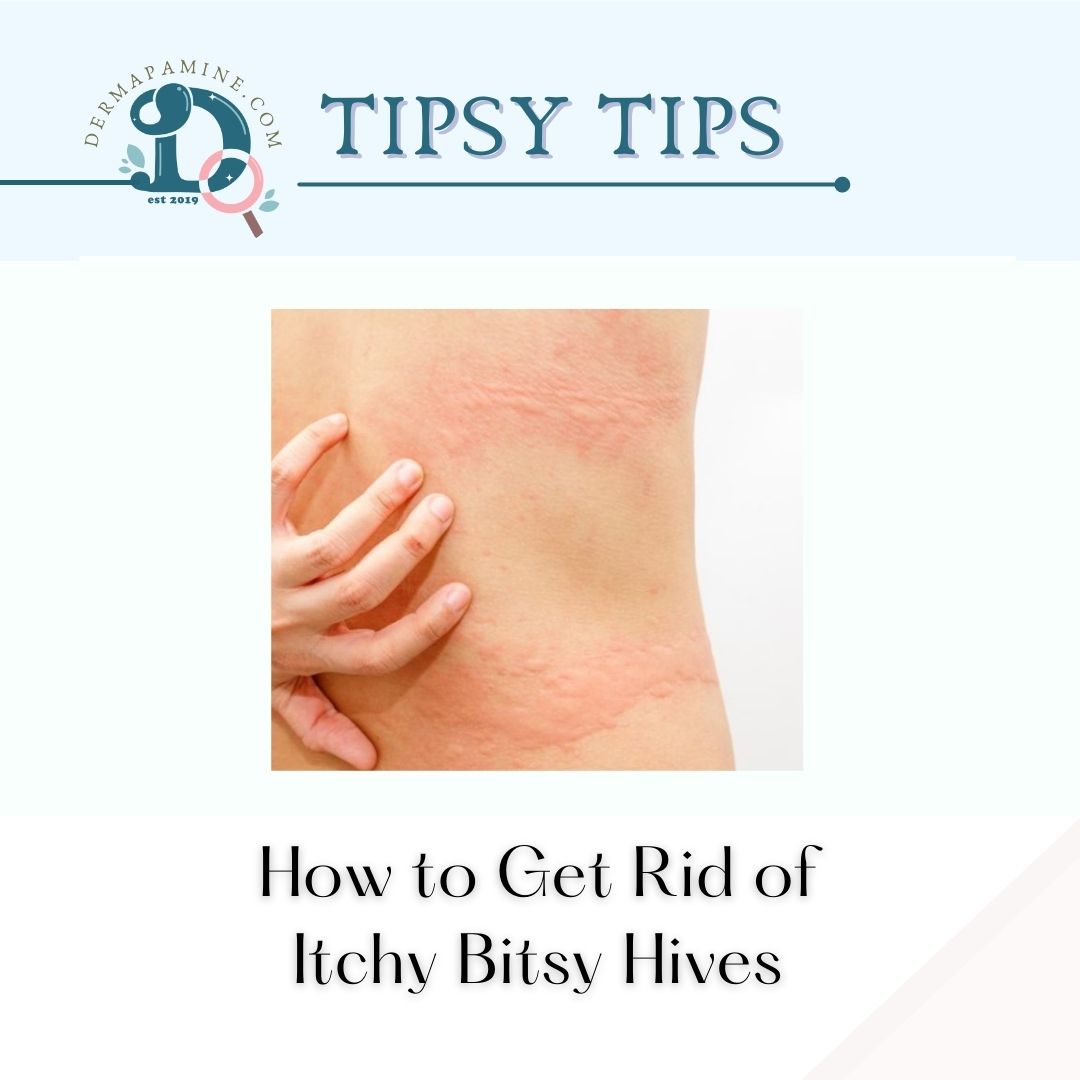 How To get rid of itchy bitsy hivEs — Acute Urticaria - dr. Ratrisha ...