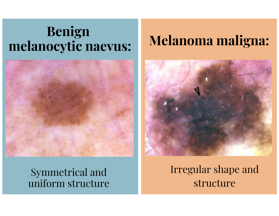 Dermoscopy — DERMAPAMINE by Dermapamine Club